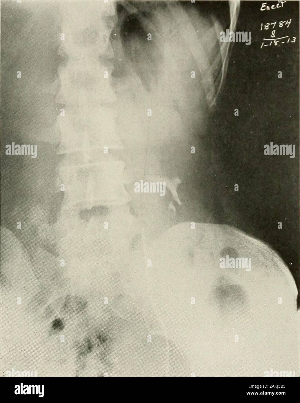 Pyelography (pyelo-ureterography) a study of the normal and pathologic ...