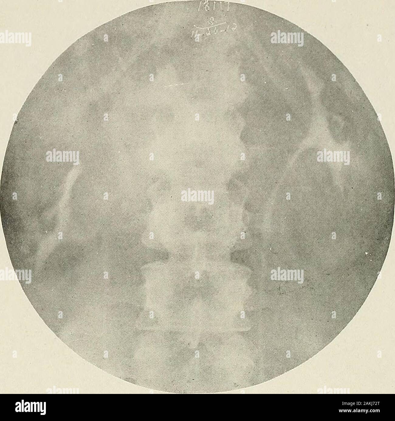 Pyelography (pyelo-ureterography) a study of the normal and pathologic ...