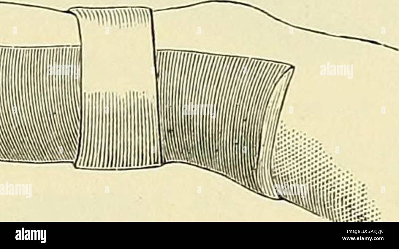 Rigid splints hi-res stock photography and images - Alamy