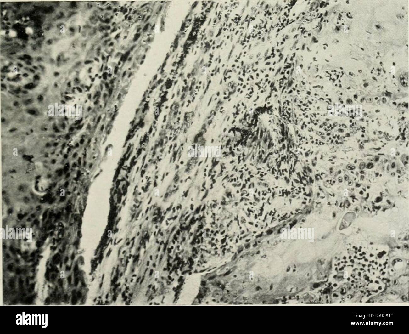 Necrotic areas hi-res stock photography and images - Alamy