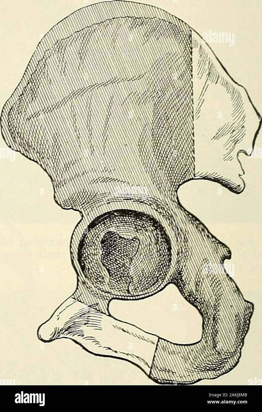 Modern surgery, general and operative . Fig. gg7.—Keen and DaCostas ...