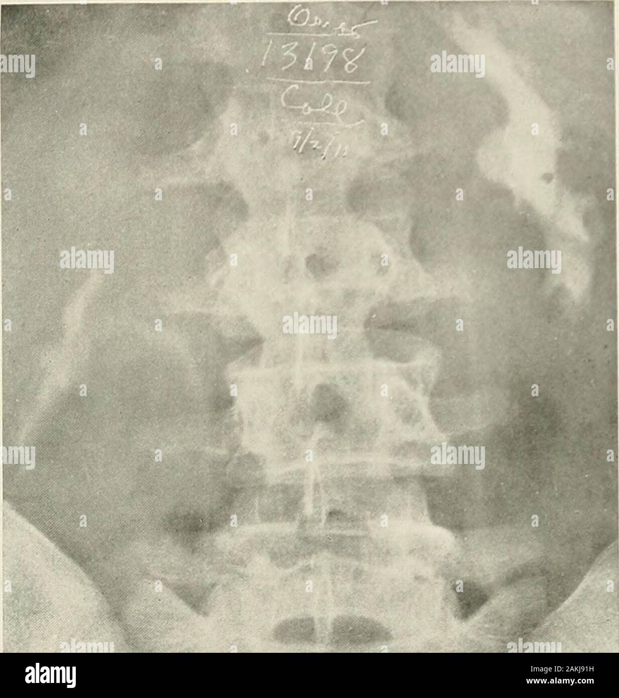 Pyelography (pyelo-ureterography) a study of the normal and pathologic ...