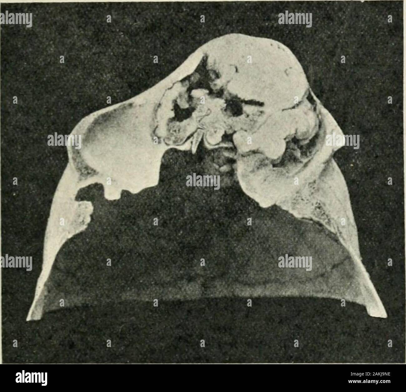 Osteoma hi-res stock photography and images - Alamy