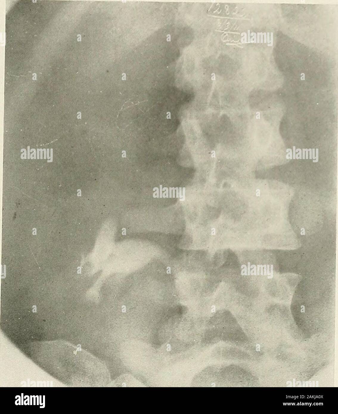 Pyelography (pyelo-ureterography) a study of the normal and pathologic ...