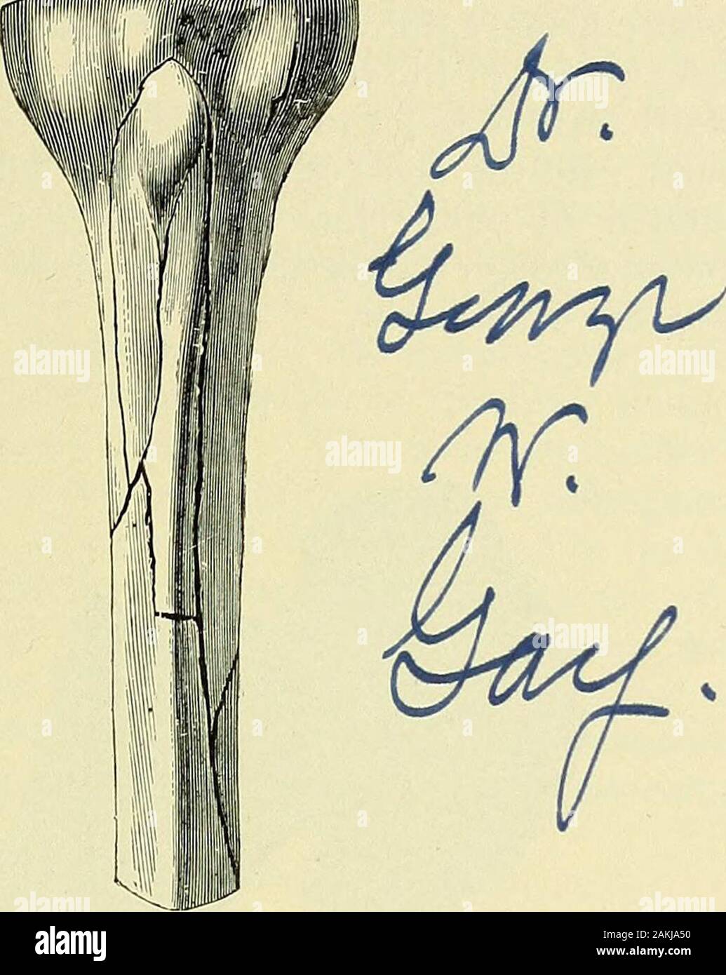 Impacted fracture hi-res stock photography and images - Alamy