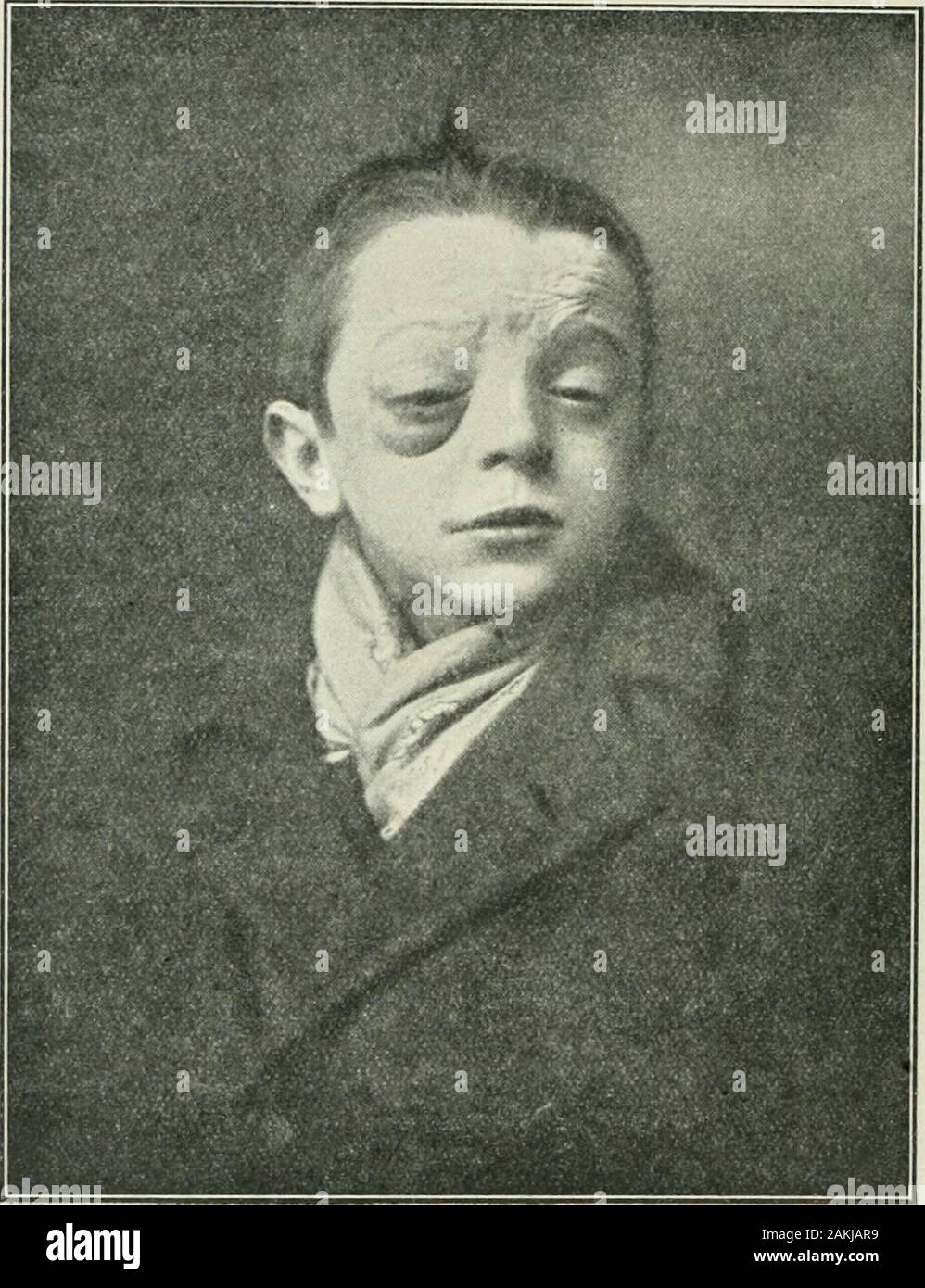 Caruncle hi-res stock photography and images - Alamy