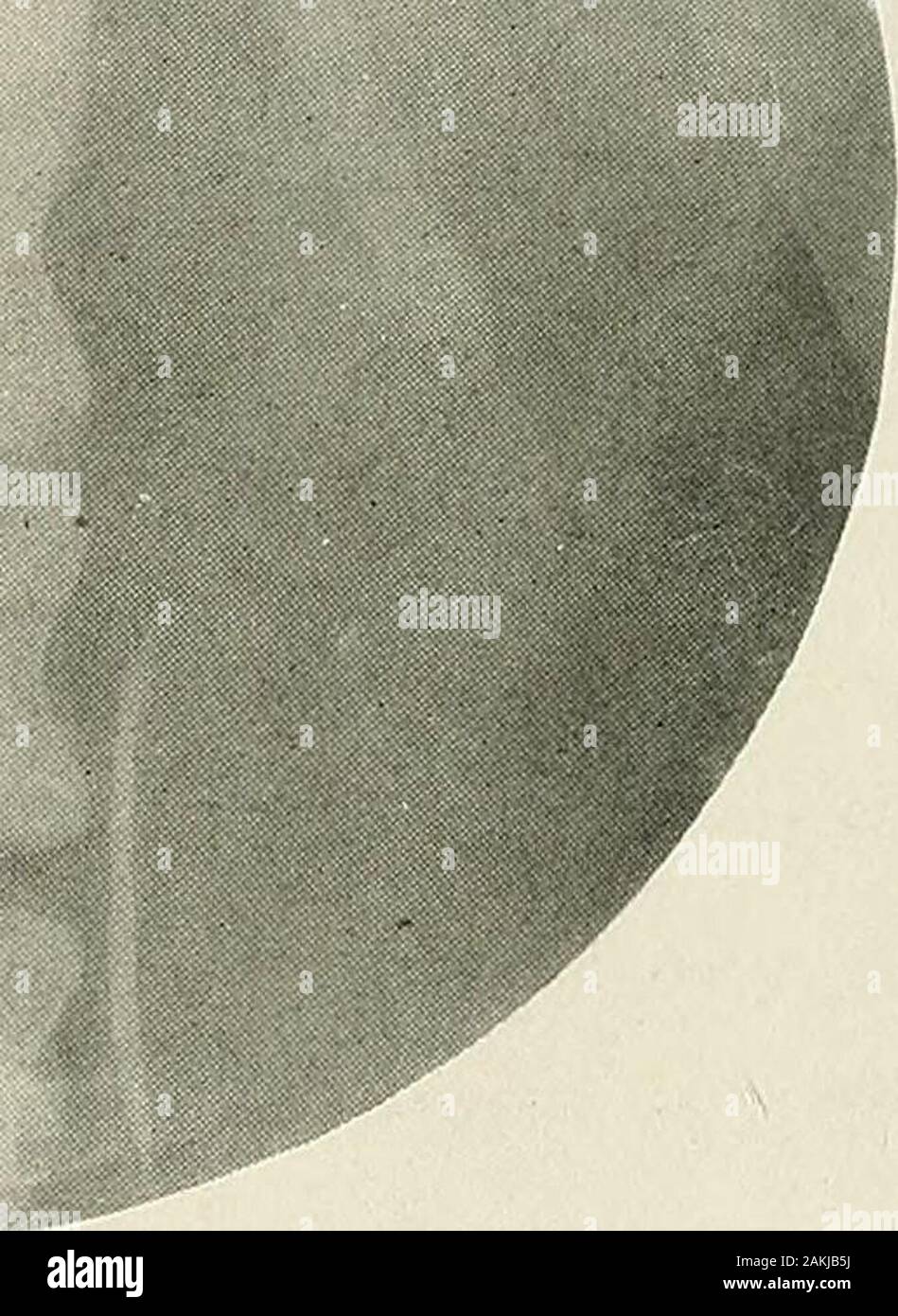Pyelography (pyelo-ureterography) a study of the normal and pathologic ...