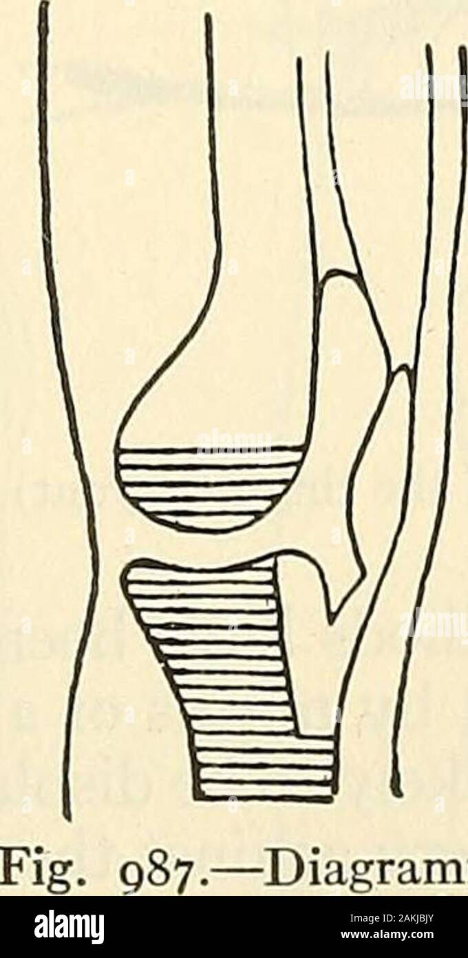 Modern surgery, general and operative . Fig. 986.- -Diagrammatic ...
