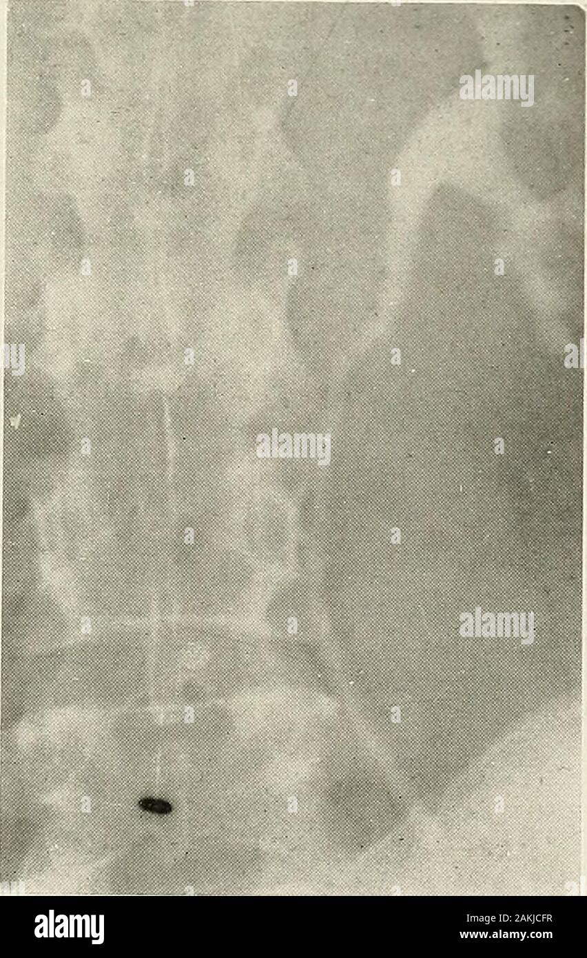 Pyelography (pyelo-ureterography) a study of the normal and pathologic ...