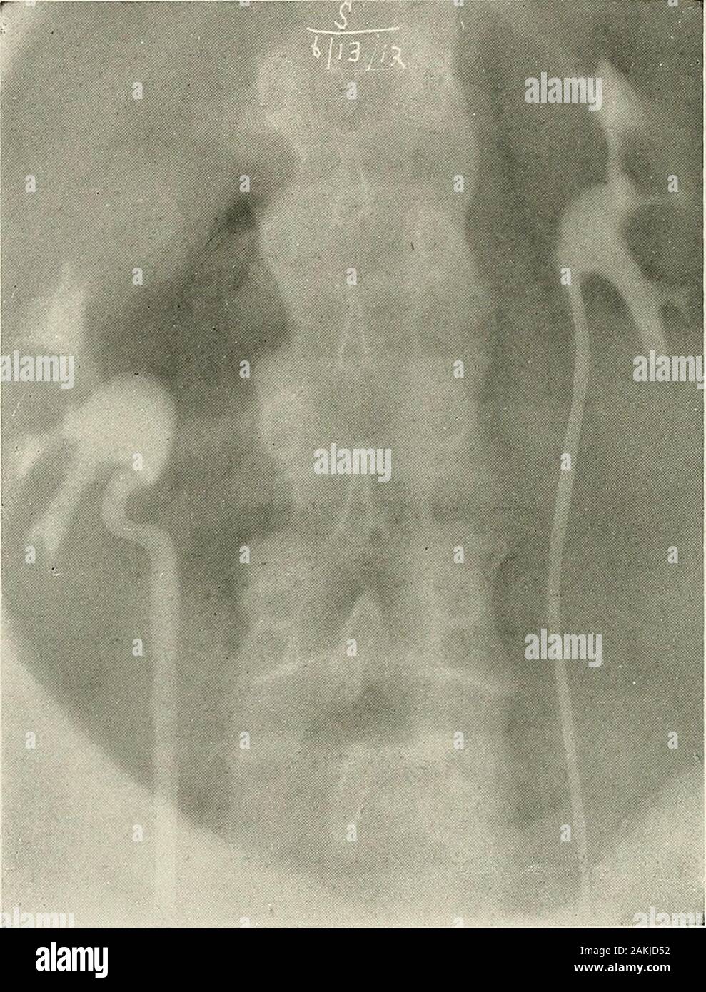 Pyelography (pyelo-ureterography) a study of the normal and pathologic ...