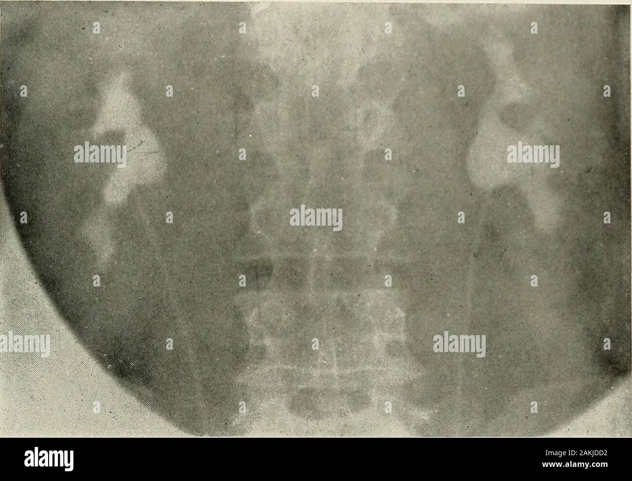Pyelography (pyelo-ureterography) a study of the normal and pathologic ...