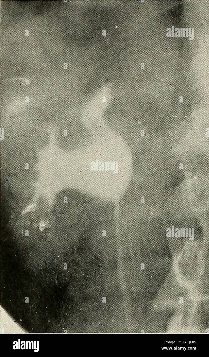 Pyelography (pyelo-ureterography) a study of the normal and pathologic ...