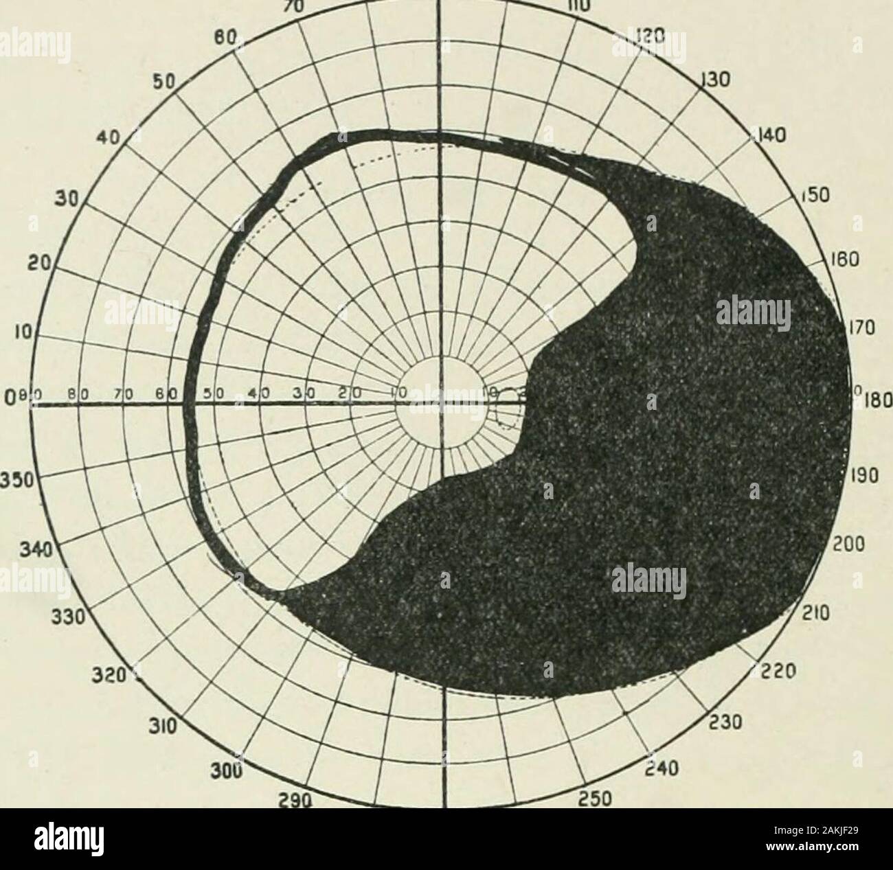 Detached retina hi-res stock photography and images - Alamy
