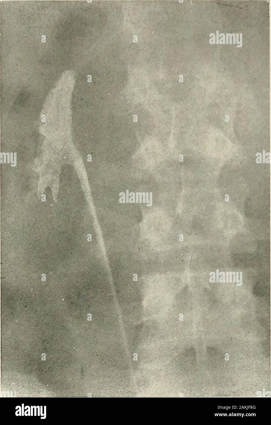 Pyelography (pyelo-ureterography) a study of the normal and pathologic ...