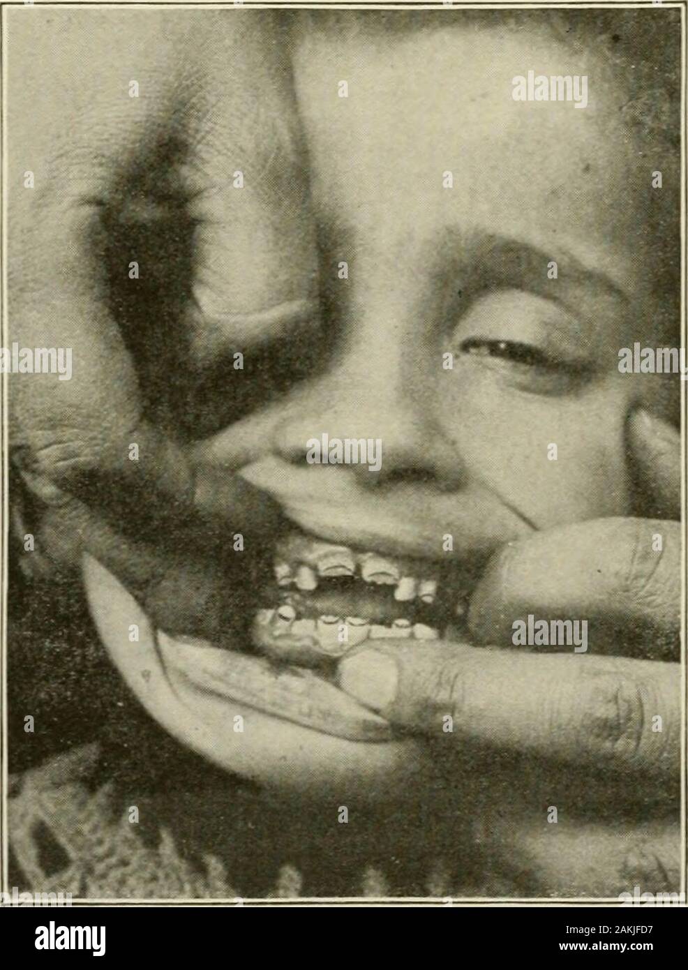 Congenital syphilis hi-res stock photography and images - Alamy