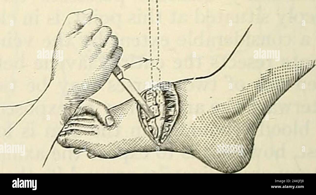 Modern surgery, general and operative . Fig. 973.—Lisfrancs amputation ...