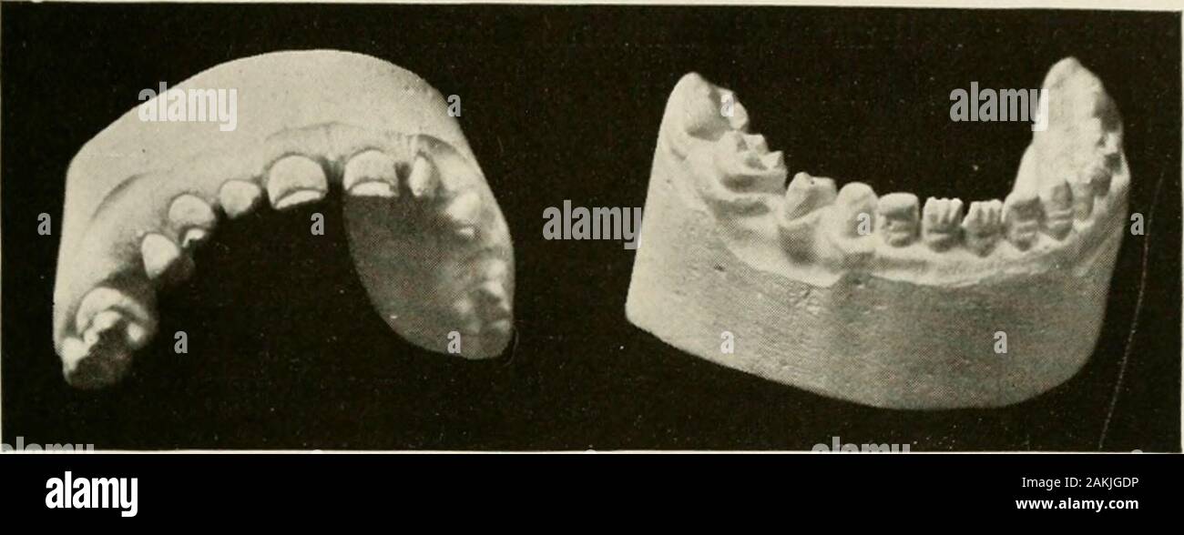Hutchinson Teeth Mulberry Molars