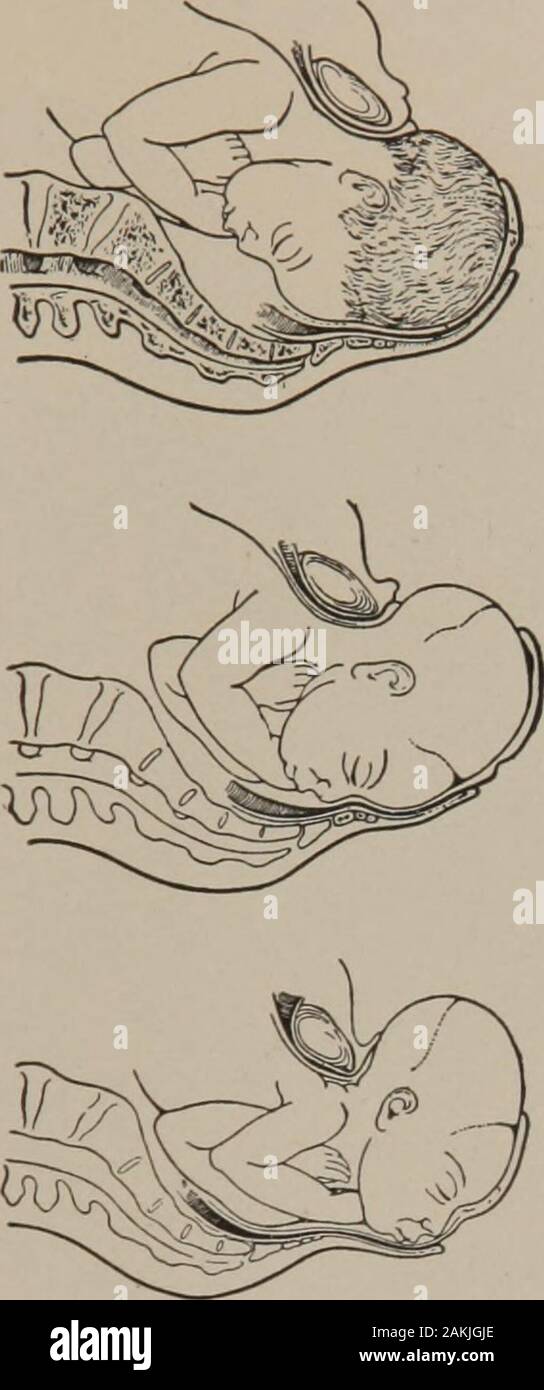 A nurse's handbook of obstetrics . FLEXION AND EXTENSION. 95 the back ...