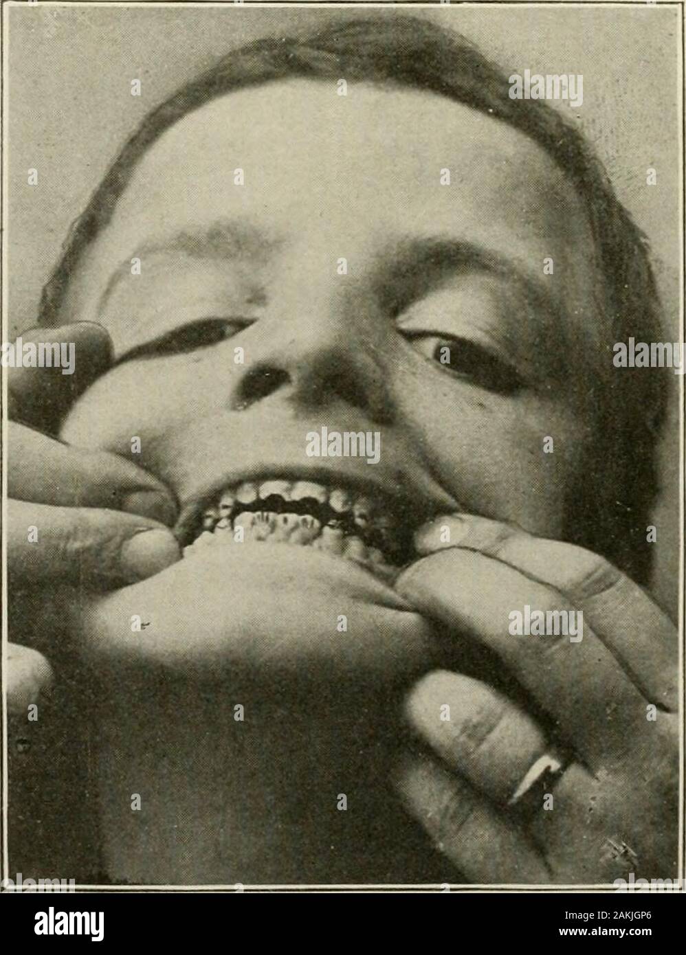 Congenital Syphilis Hutchinson Teeth