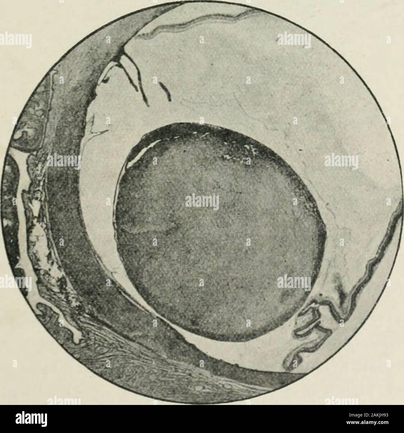 Foetal lens hi-res stock photography and images - Alamy