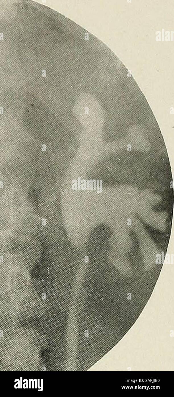 Pyelography (pyelo-ureterography) a study of the normal and pathologic ...