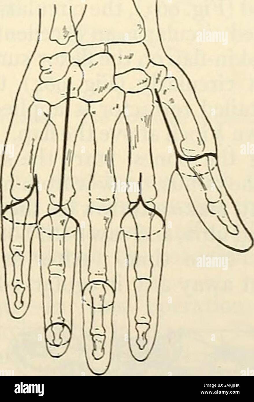 Distal phalanx of thumb hi-res stock photography and images - Alamy