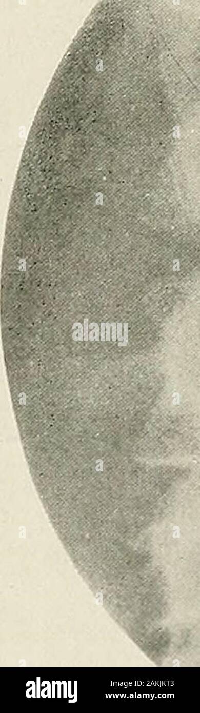 Pyelography (pyelo-ureterography) a study of the normal and pathologic ...