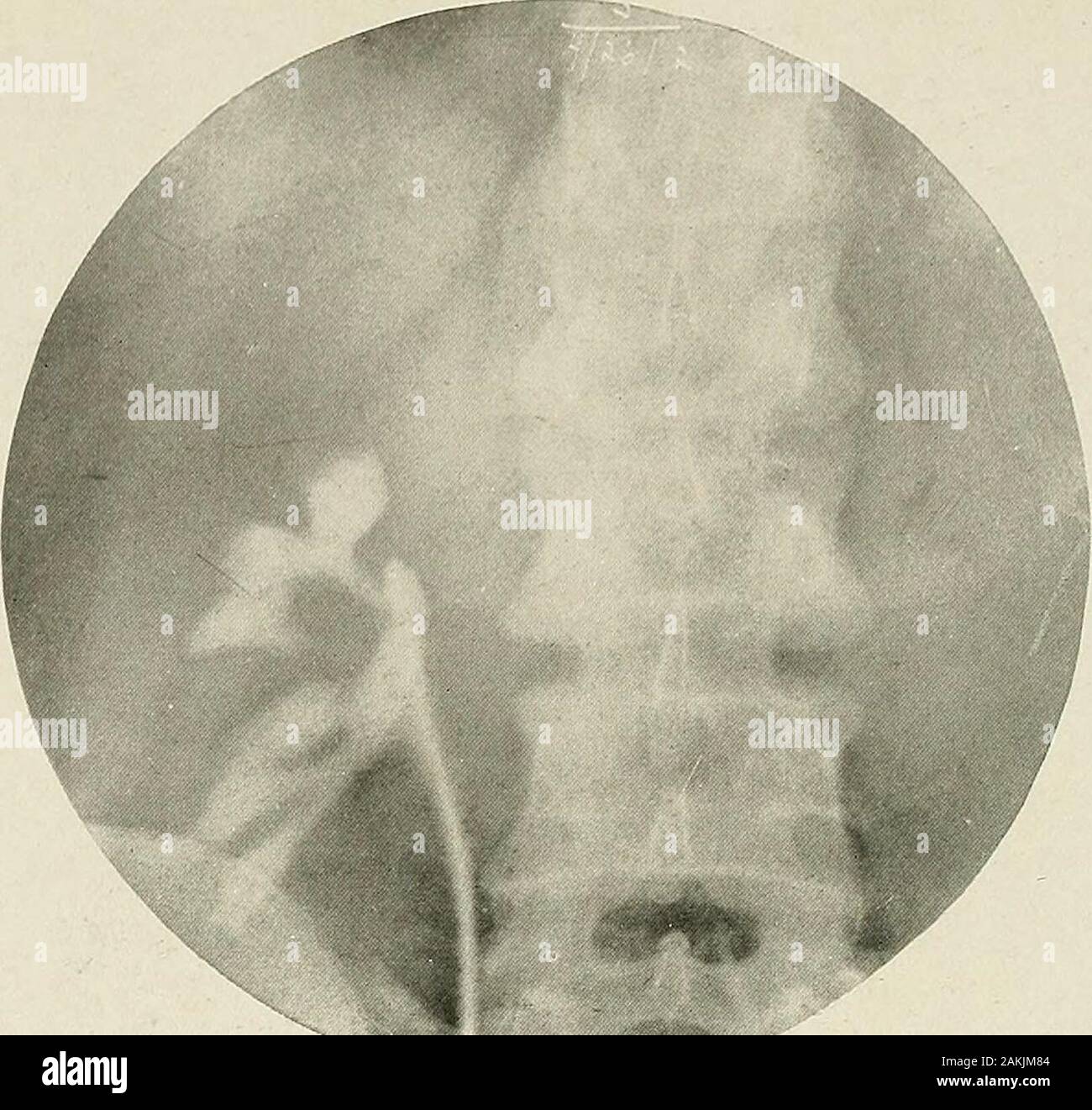 Renal calyces hi-res stock photography and images - Alamy