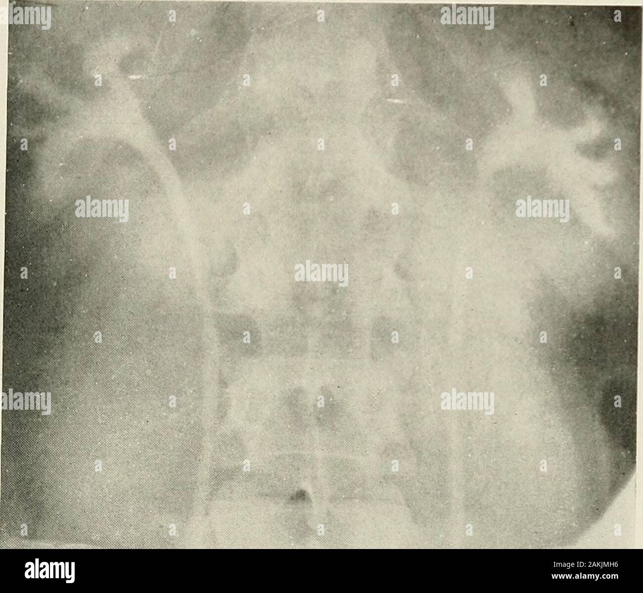 Renal Calyces Stock Photos & Renal Calyces Stock Images - Alamy