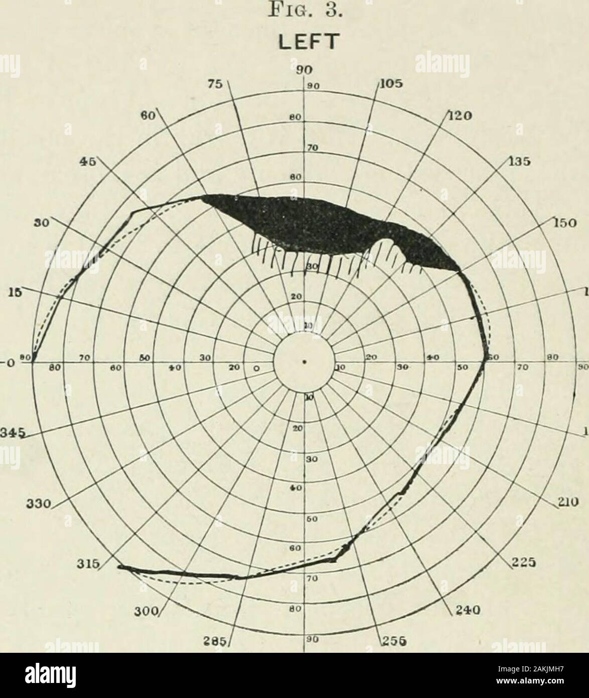Transactions . d a largedetachment in the lower temporal segment ...