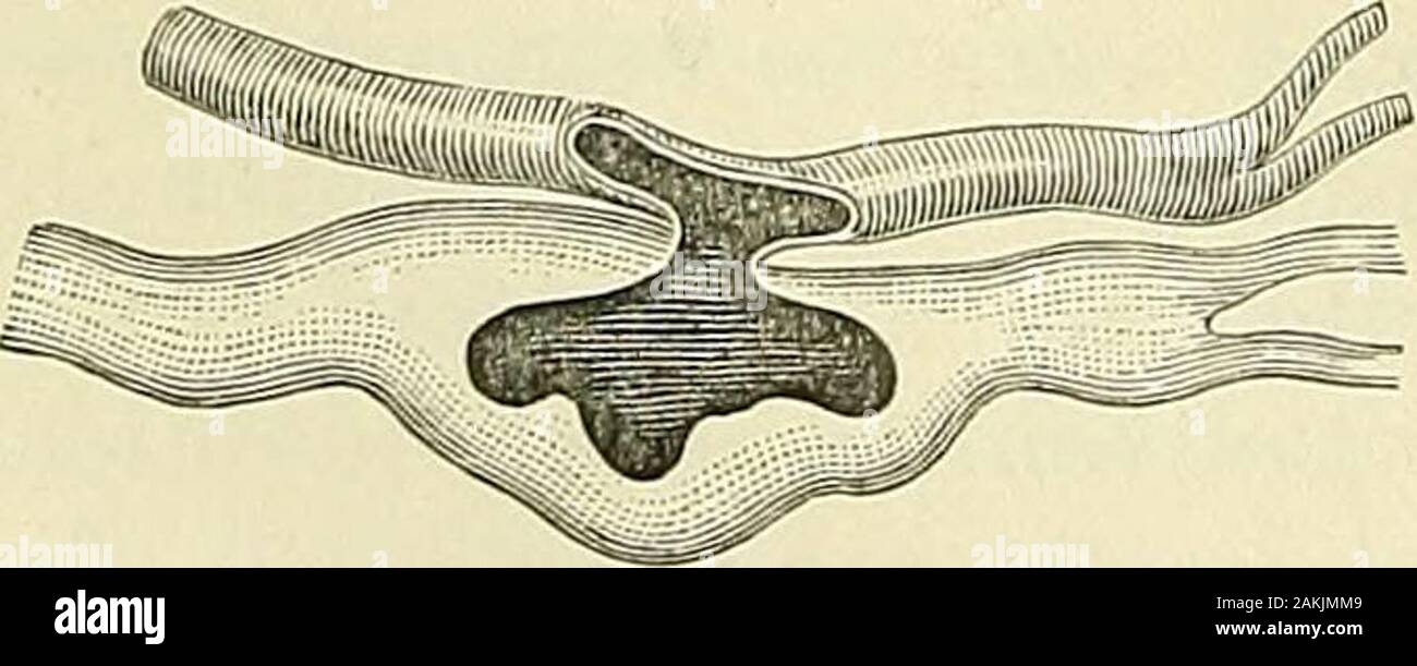 Fistule hi-res stock photography and images - Alamy