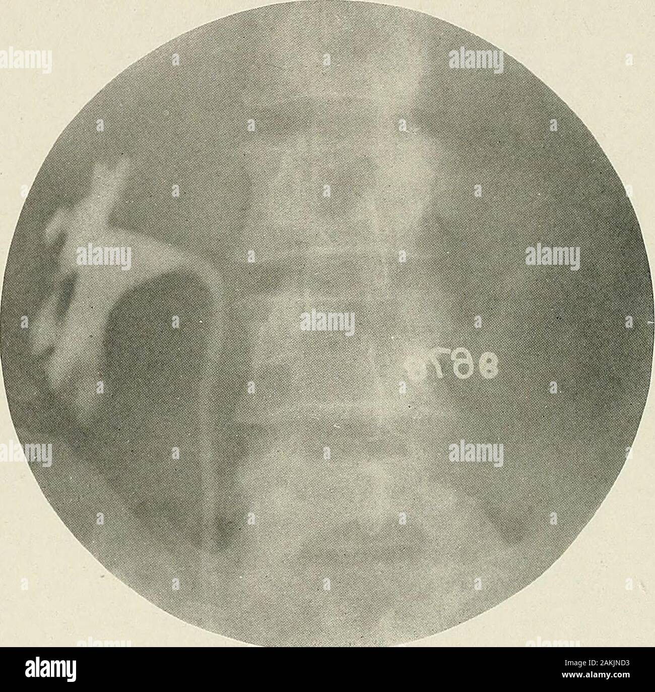 Pyelography (pyelo-ureterography) a study of the normal and pathologic ...