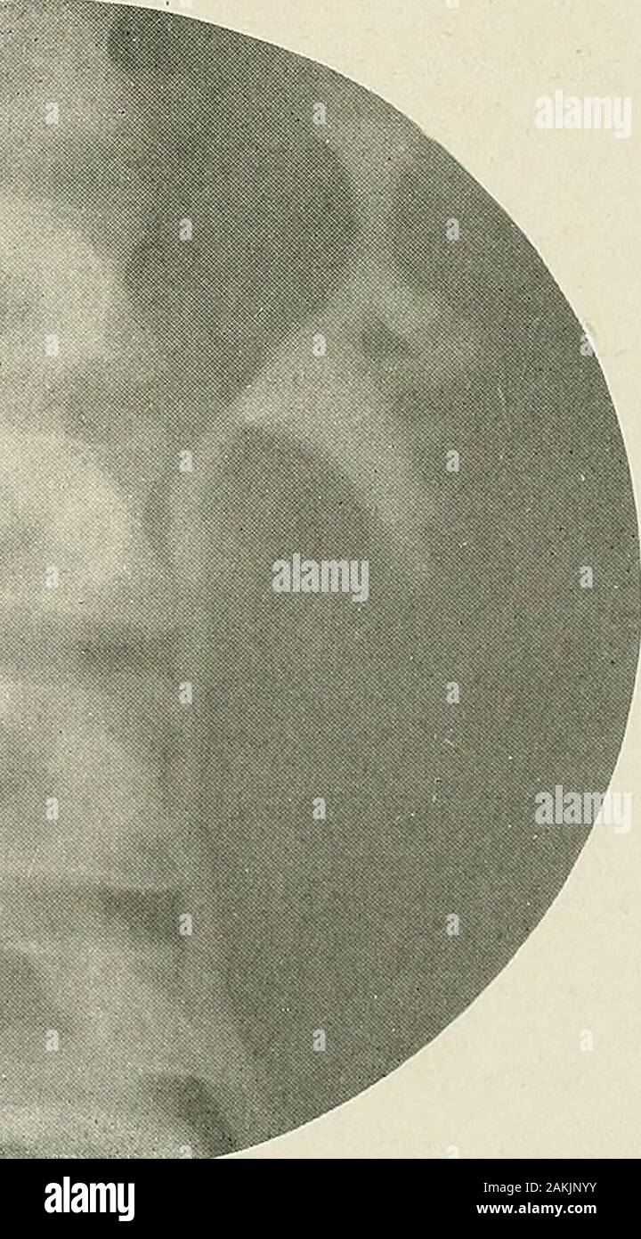 Pyelography (pyelo-ureterography) a study of the normal and pathologic ...