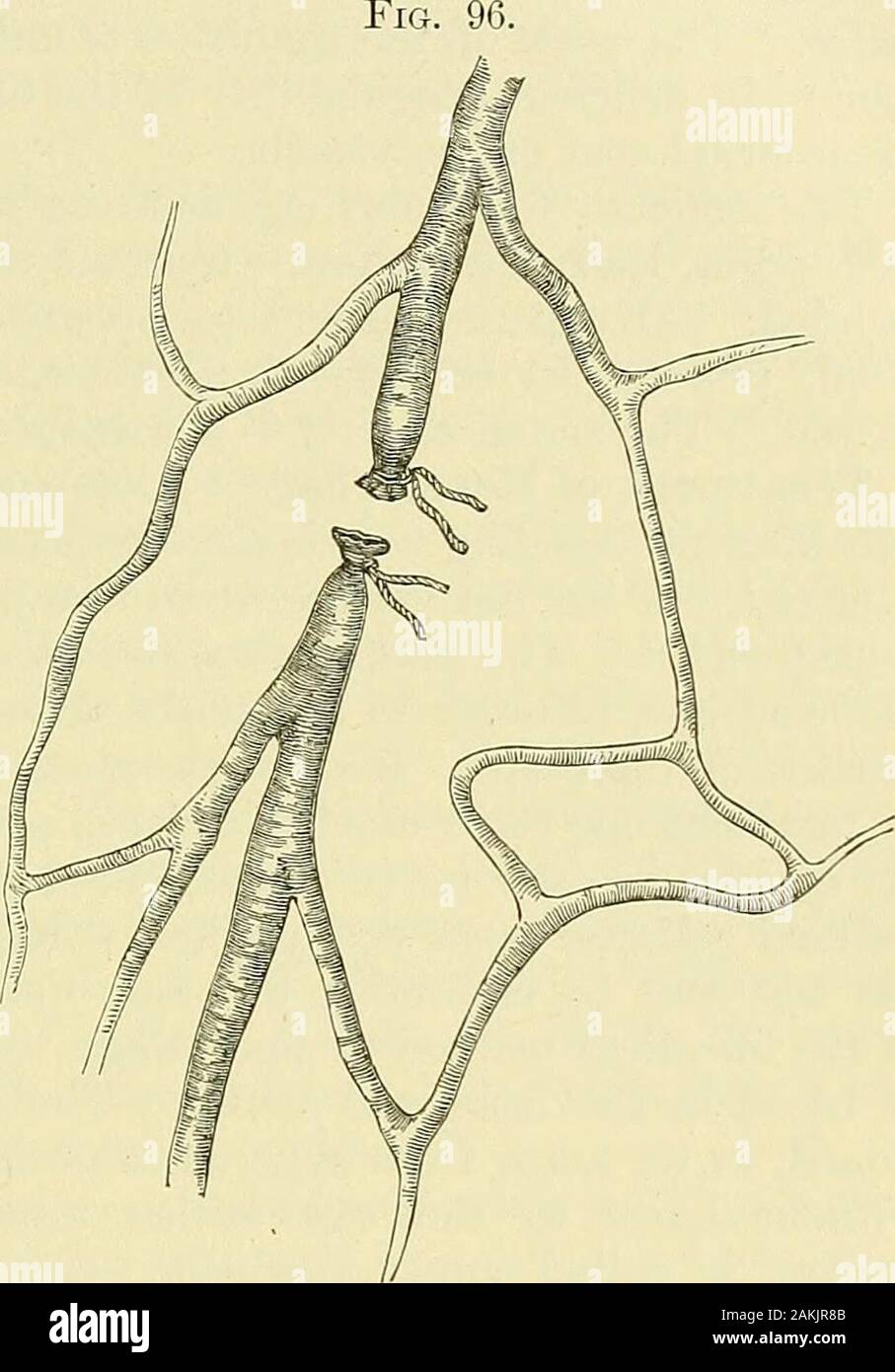 Venous gangrene hi-res stock photography and images - Alamy