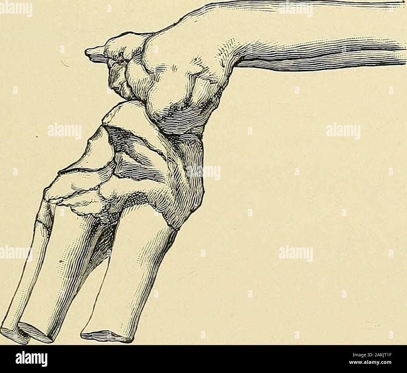Notes on the modern treatment of fractures . Fig. 26.. Fig. 27. Two ...
