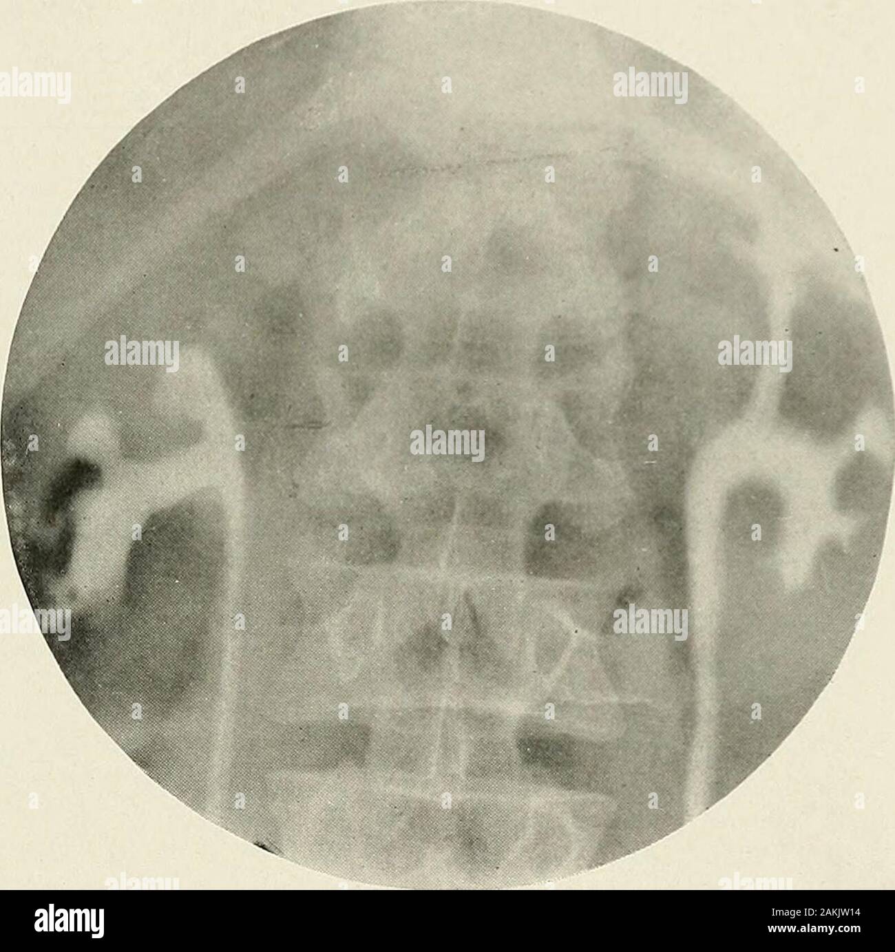 Pyelography (pyelo-ureterography) a study of the normal and pathologic ...