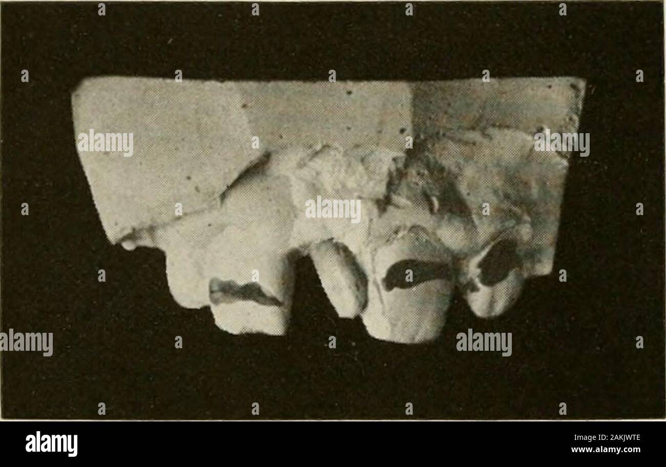 Abnormalities of teeth hi-res stock photography and images - Alamy