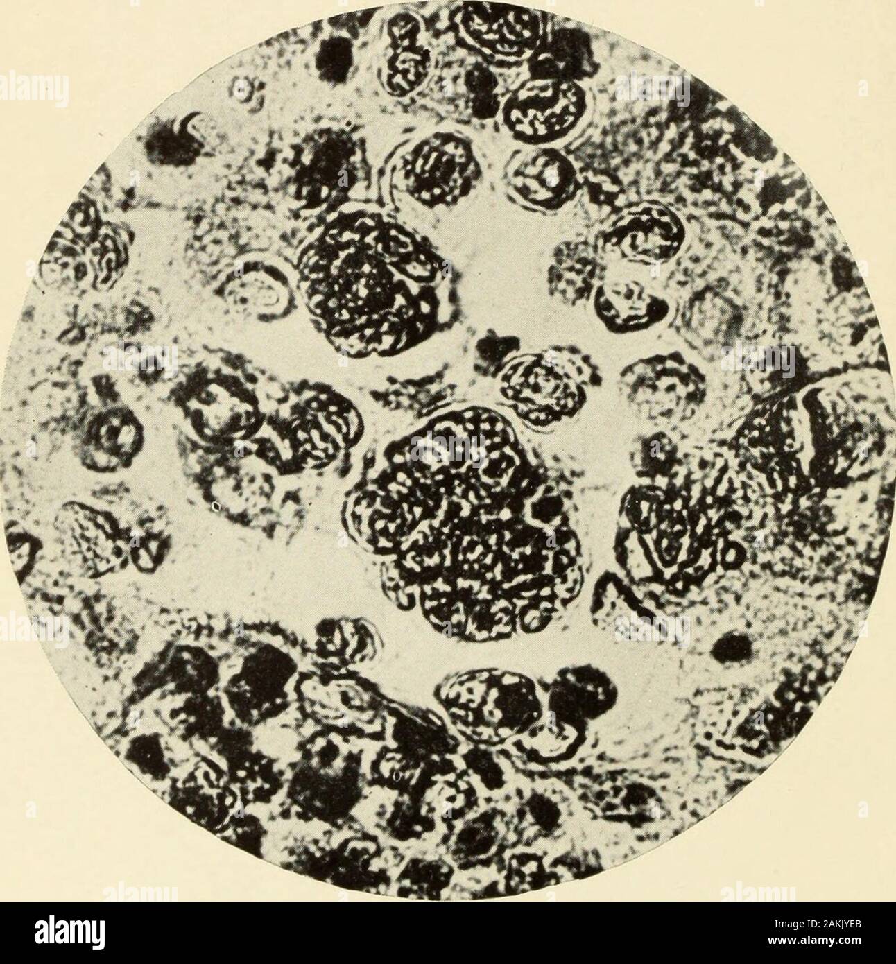 Uncinariasis (Hookworm disease) in Porto Rico : a medical and economic ...