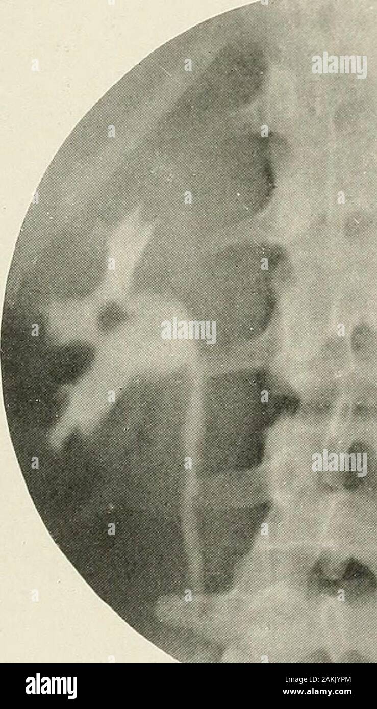 Pyelography (pyelo-ureterography) a study of the normal and pathologic ...