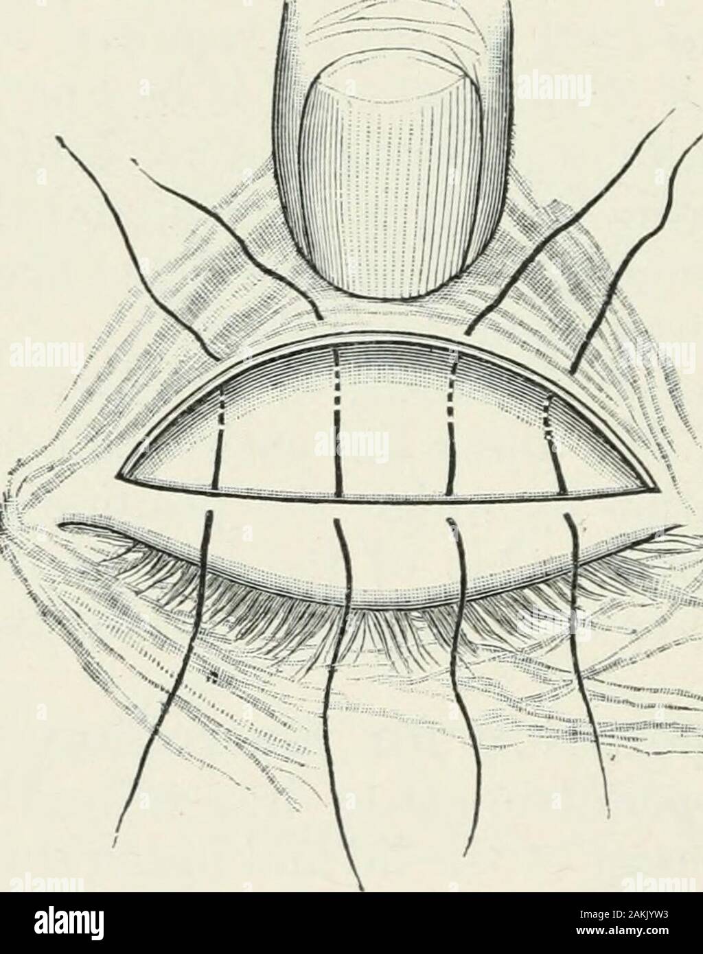 External incision hi-res stock photography and images - Alamy