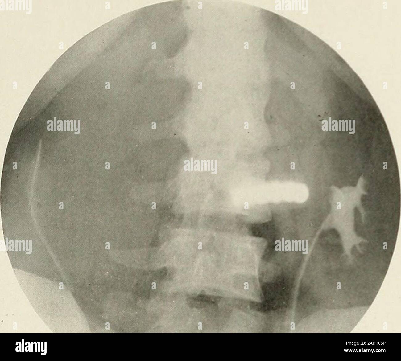 Pyelography (pyelo-ureterography) a study of the normal and pathologic ...