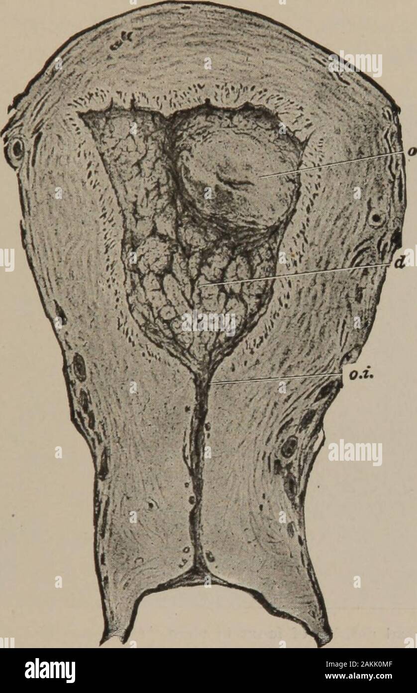 Capsular decidua hi-res stock photography and images - Alamy
