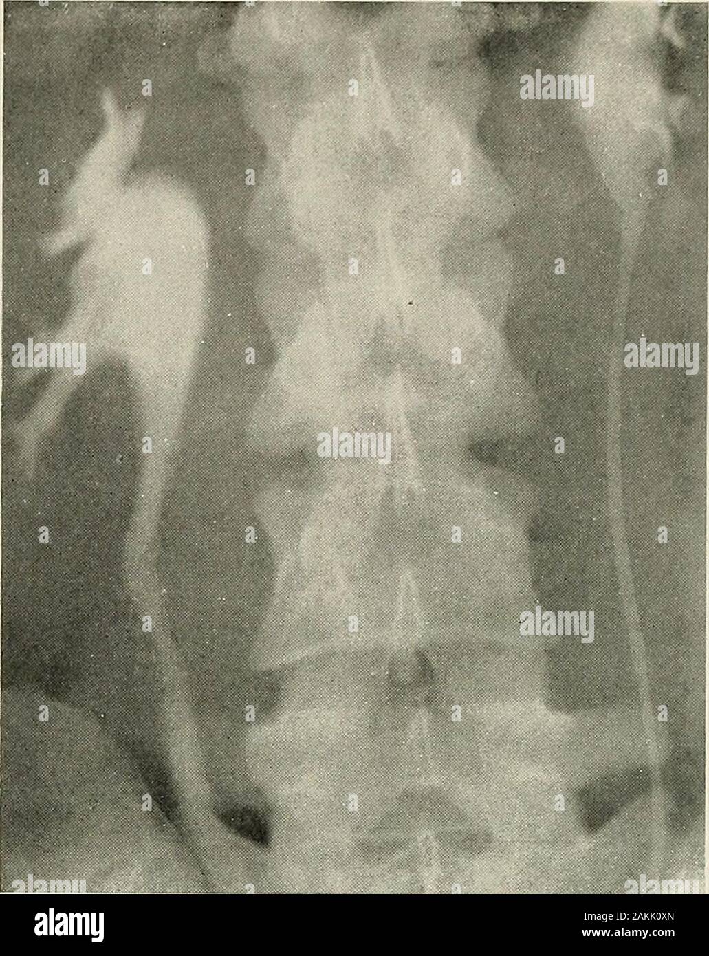 Pyelography (pyelo-ureterography) a study of the normal and pathologic ...