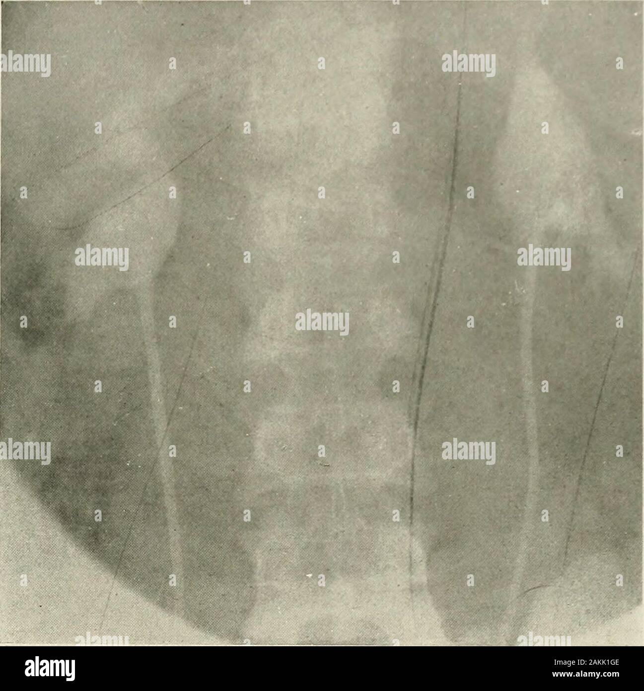 Pyelography (pyelo-ureterography) a study of the normal and pathologic ...