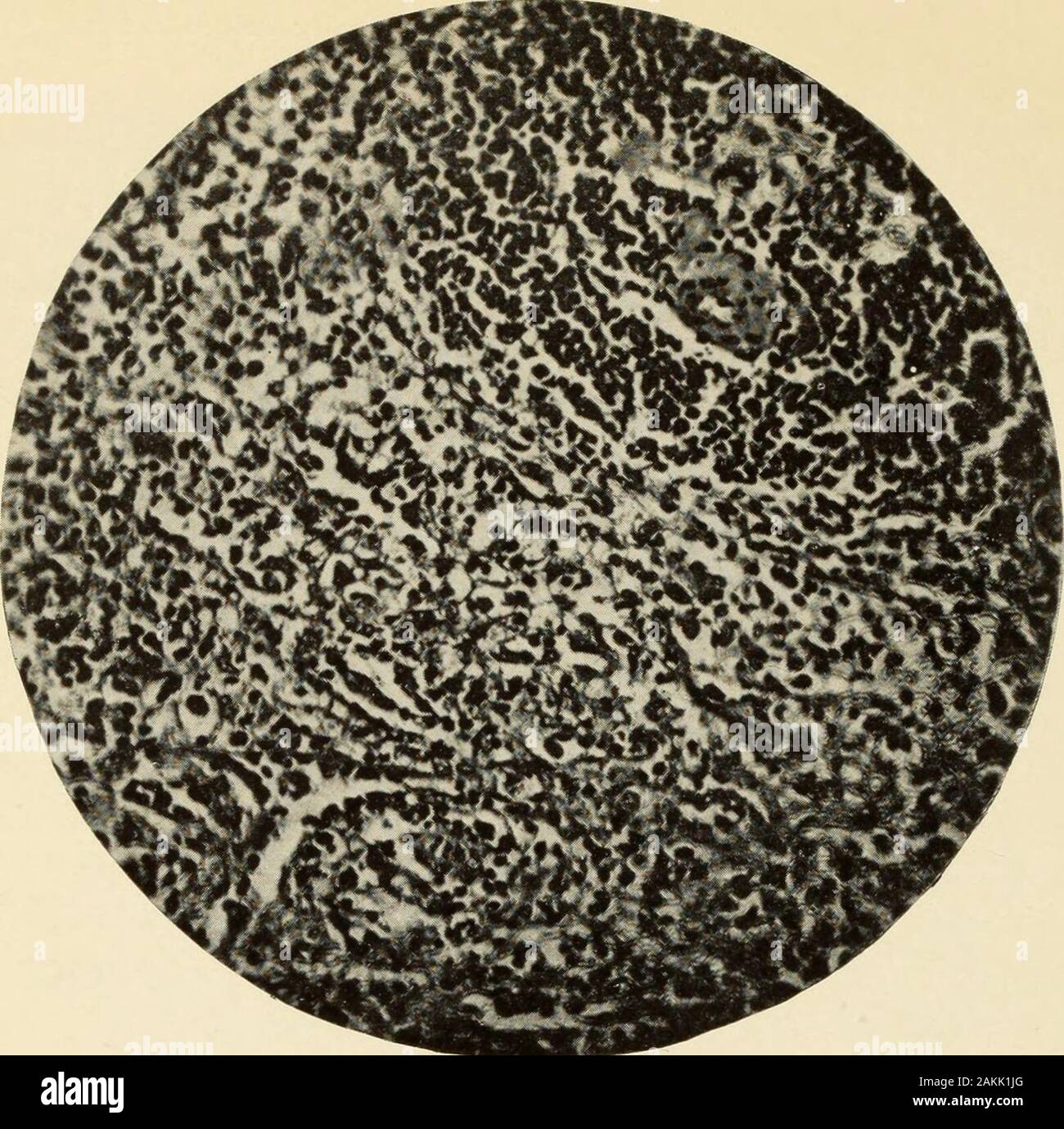 Uncinariasis (Hookworm disease) in Porto Rico : a medical and economic ...