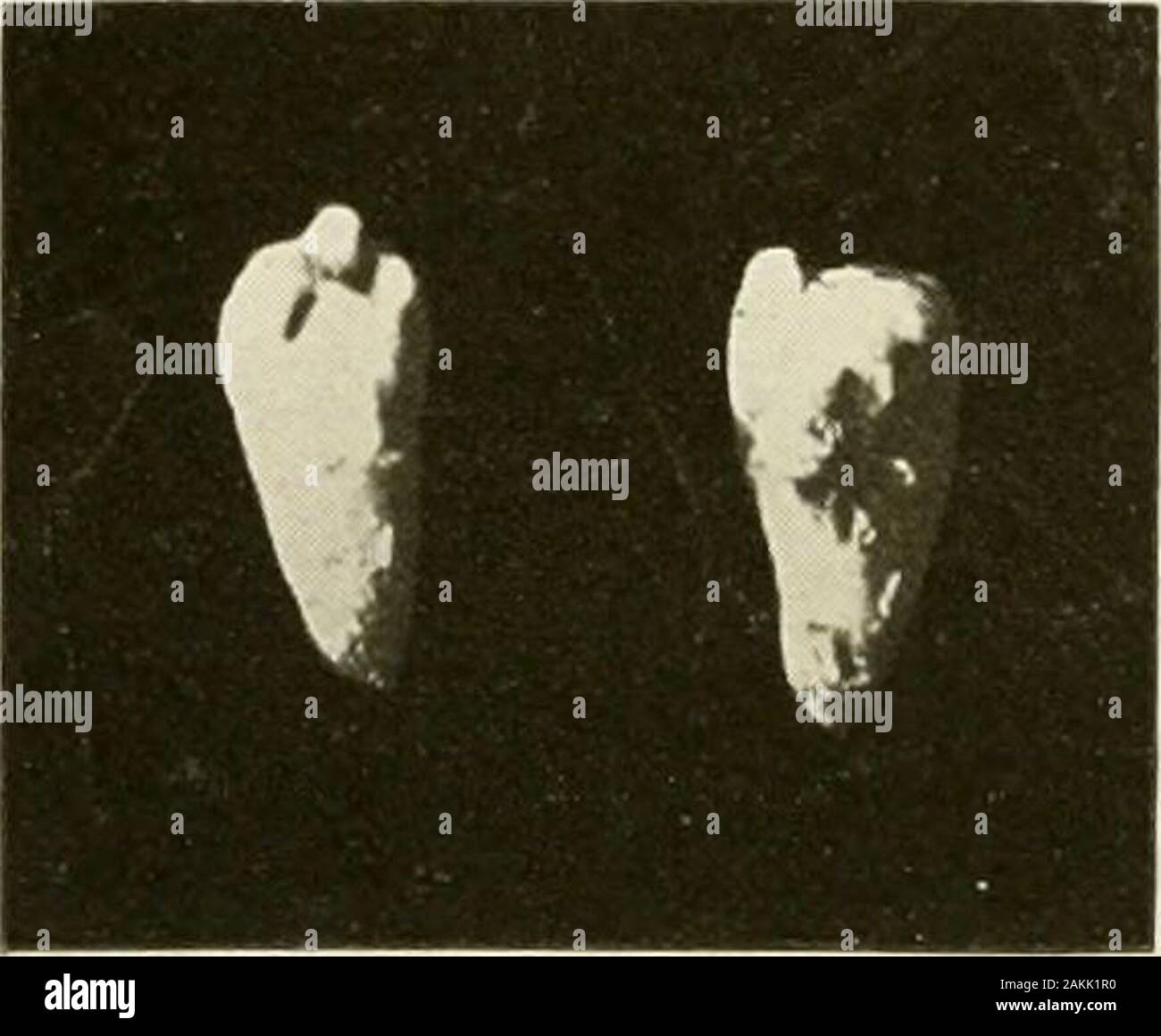 Third molar hi-res stock photography and images - Alamy