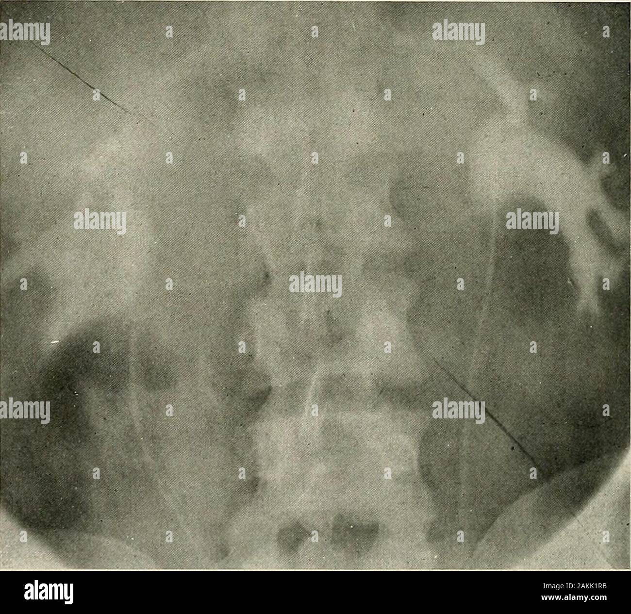 Pyelography (pyelo-ureterography) a study of the normal and pathologic ...