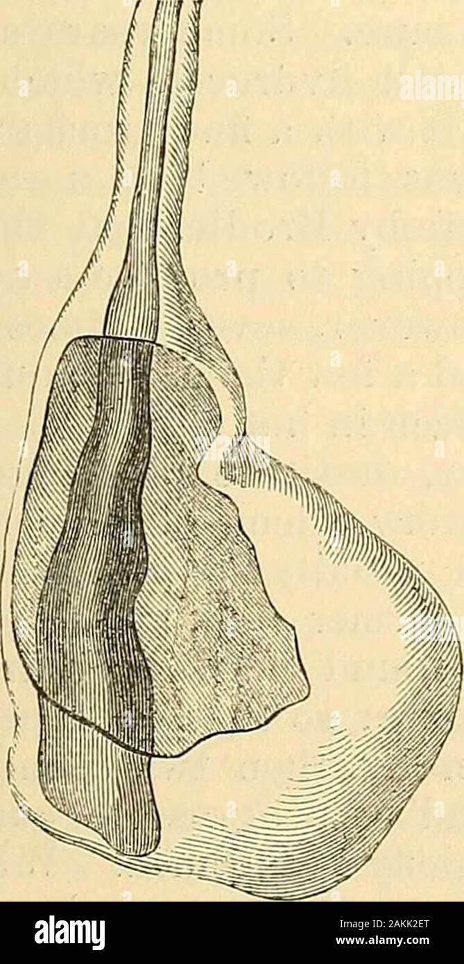 Hydrocele hi-res stock photography and images - Alamy