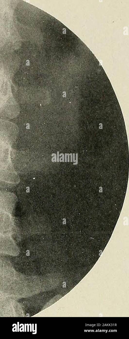 Pyelography (pyelo-ureterography) a study of the normal and pathologic ...