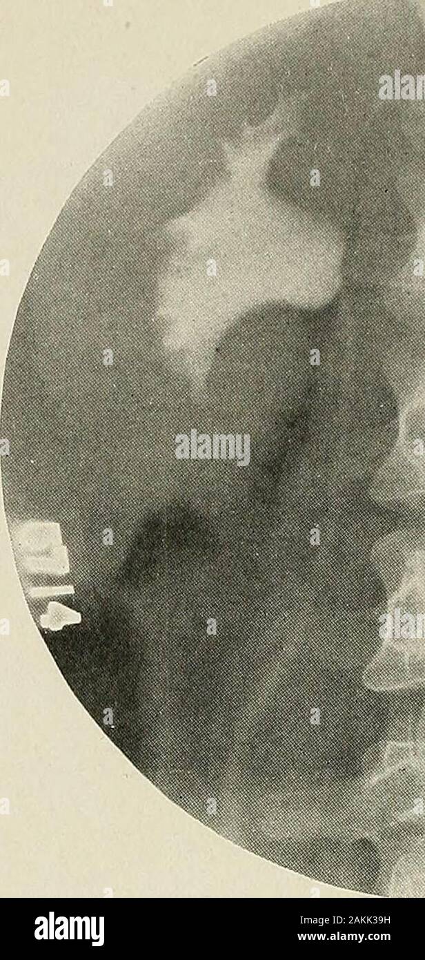 Pyelography (pyelo-ureterography) a study of the normal and pathologic ...